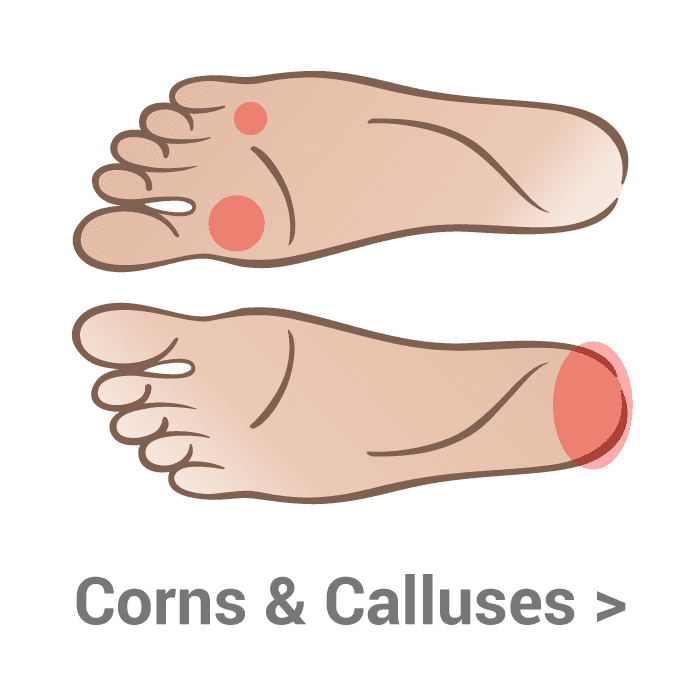 Corns & Calluses | Kassis Brother's Shoes